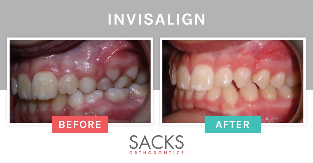 Before and After Invisalign: Unlocking Your Best Smile